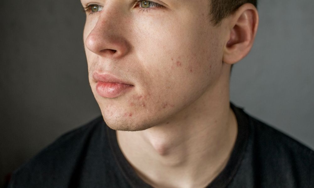4 Surprising Things You Might Not Know About Acne 4 Surprising Things You Might Not Know About Acne